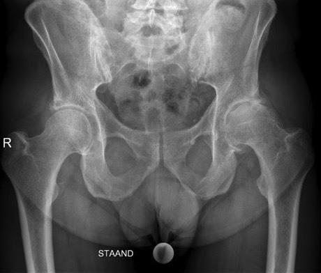 Heup prothese | Orthopedie Izegem