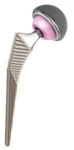 Heup prothese | Orthopedie Izegem