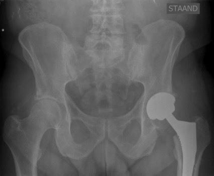 Heup prothese | Orthopedie Izegem